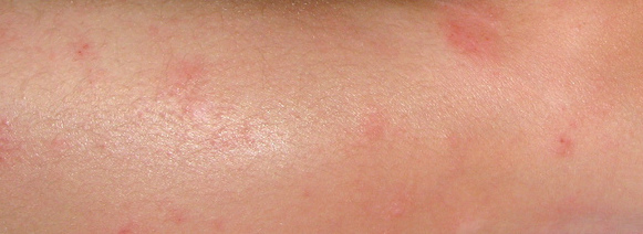 Soulager l'eczéma - Cabinet de santé Équilibre